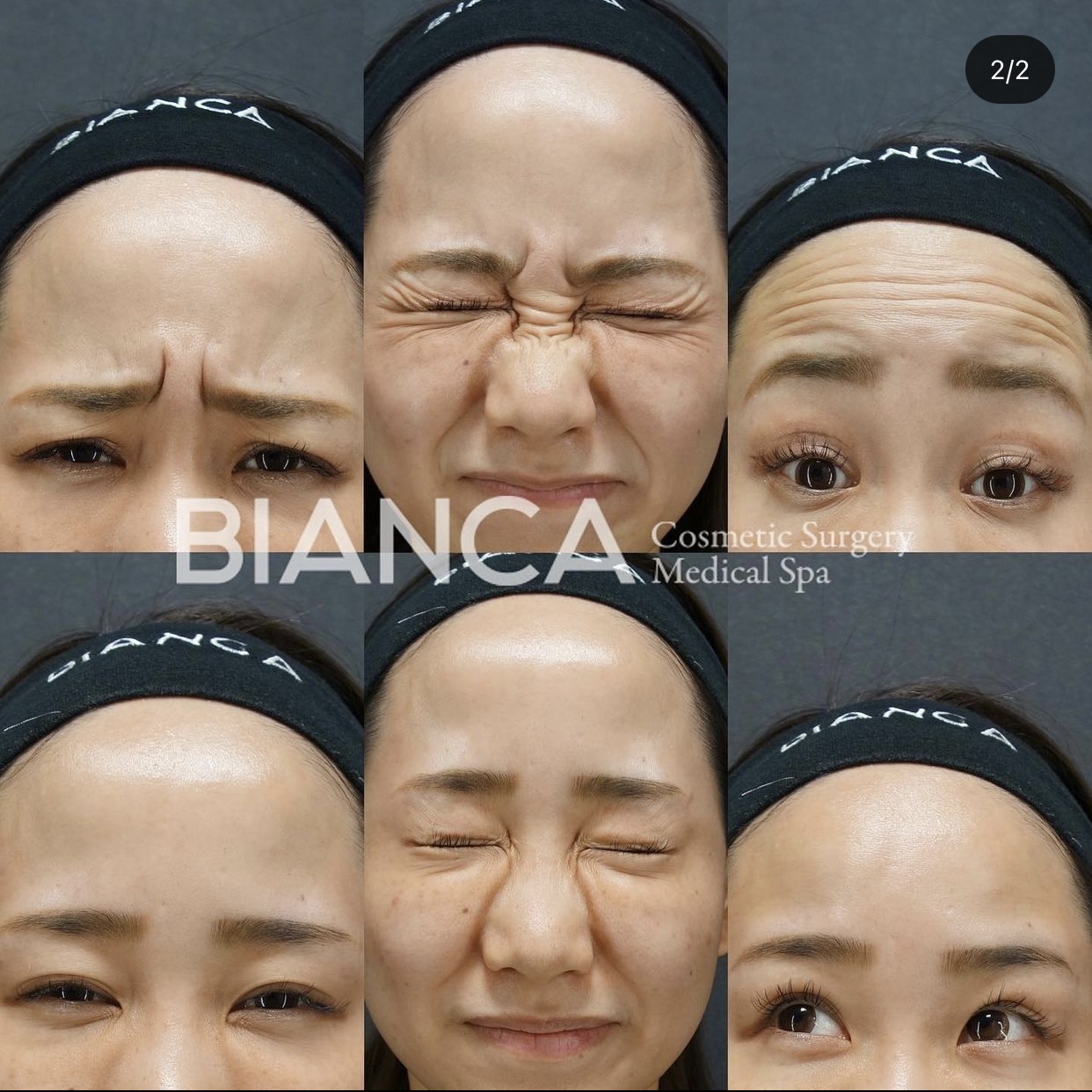 ボトックスフェイシャル | ビアンカクリニック